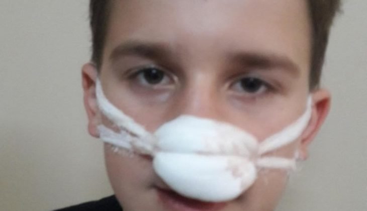 Nas Spart (fractura Nazală): Cauze, Simptome și Tratament - ThePOC